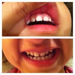 Discovering And Correcting Lip Tie On A Toddler And An Infant